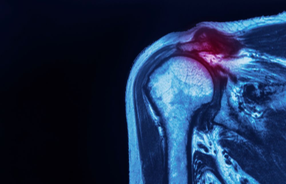 Workers' Comp SLAP Tear Settlements (Breakdown) | Scher, Bassett & Hames